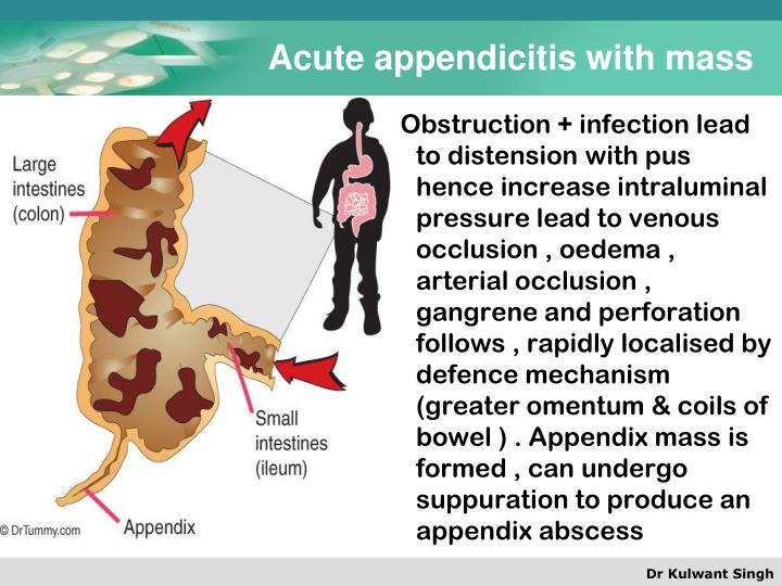 PPT - APPENDICITIS PowerPoint Presentation - ID:1703196