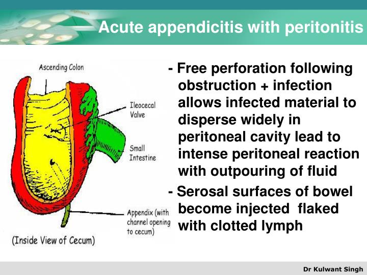 PPT - APPENDICITIS PowerPoint Presentation - ID:1703196