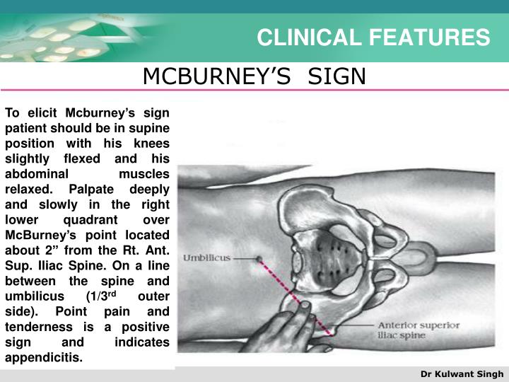 PPT - APPENDICITIS PowerPoint Presentation - ID:1703196
