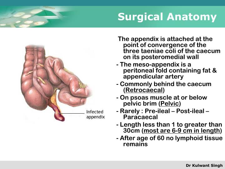 PPT - APPENDICITIS PowerPoint Presentation - ID:1703196