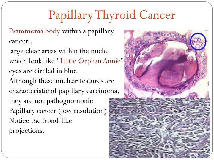 Ppt Papillary Thyroid Carcinoma Powerpoint Presentation Id 1703808