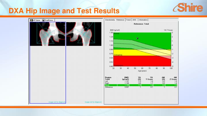 PPT - Gaucher Disease: Bone Imaging PowerPoint Presentation - ID:1704009