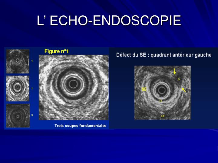 PPT - FISSURE ANALE PowerPoint Presentation - ID:1704087