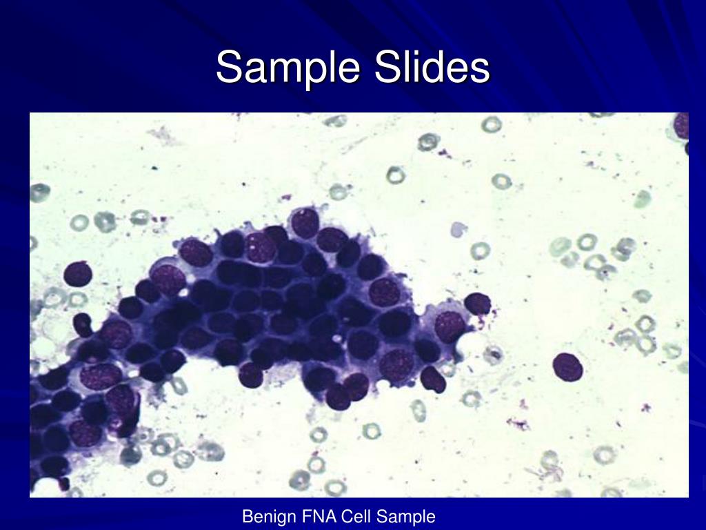 PPT - Improved Design for Fine-Needle Aspiration (FNA) of Breast Cancer ...