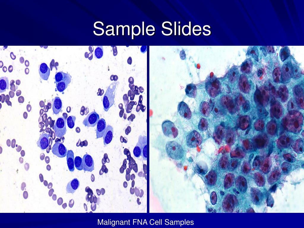 PPT - Improved Design for Fine-Needle Aspiration (FNA) of Breast Cancer ...