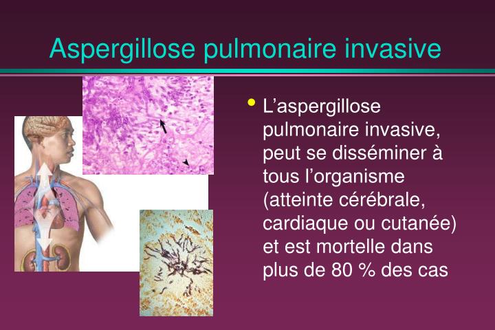 Quels Sont Les Symptômes De L’Aspergillose Pulmonaire Invasive – WHKRQ