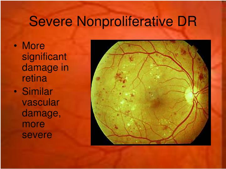 Nonproliferative Vs Proliferative Retinopathy