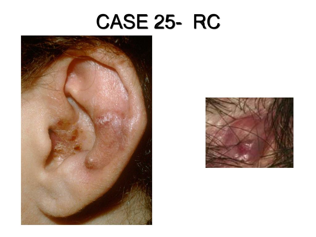 PPT - Case25: 35 y.o. Female. Lesion on the ear. Haemangioma? Lymphoma ...