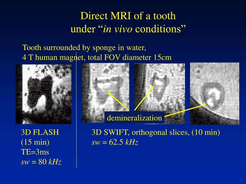 PPT - Direct MRI of Human Teeth using SWIFT Djaudat Idiyatullin, Curt ...