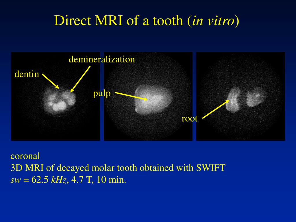 PPT - Direct MRI of Human Teeth using SWIFT Djaudat Idiyatullin, Curt ...