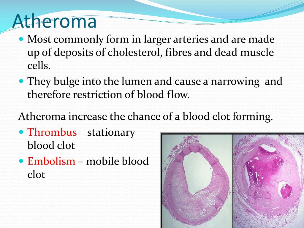 PPT - The heart and heart disease PowerPoint Presentation, free ...