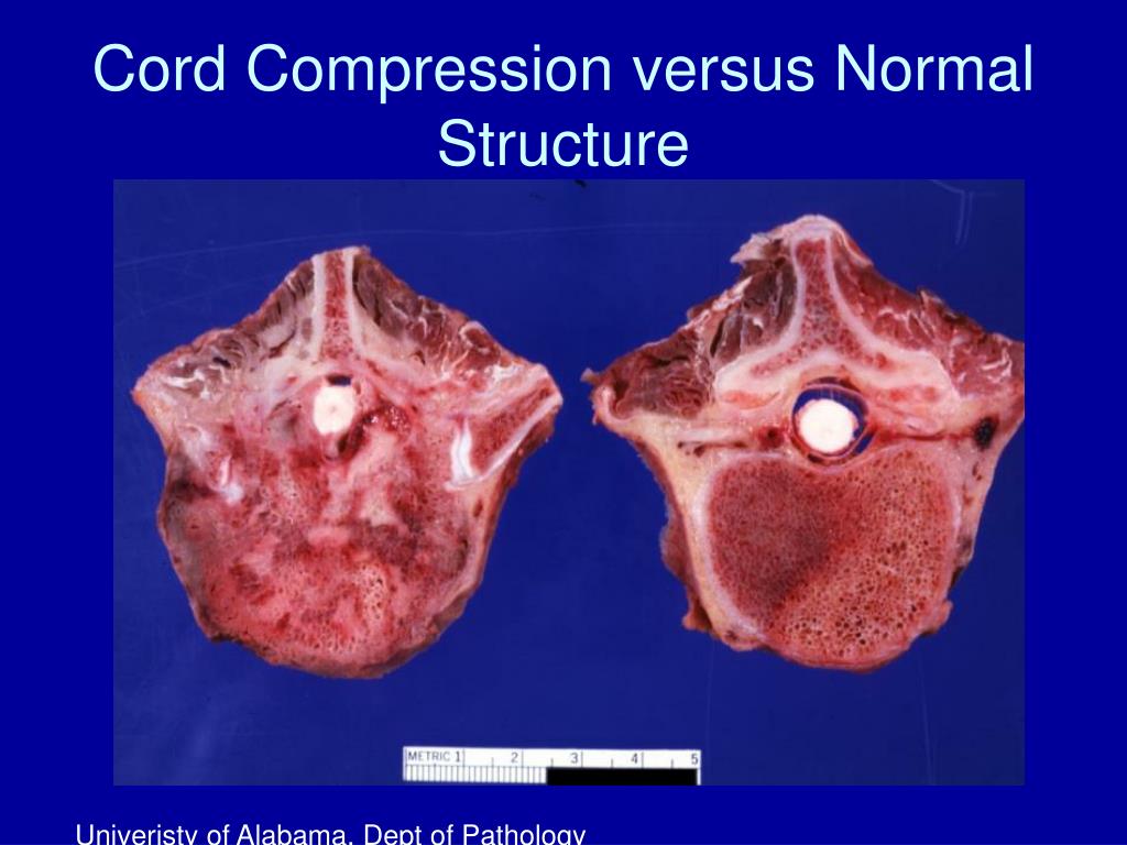 PPT - Back and Neck Pain in Patients with Metastatic Disease: Assessing ...