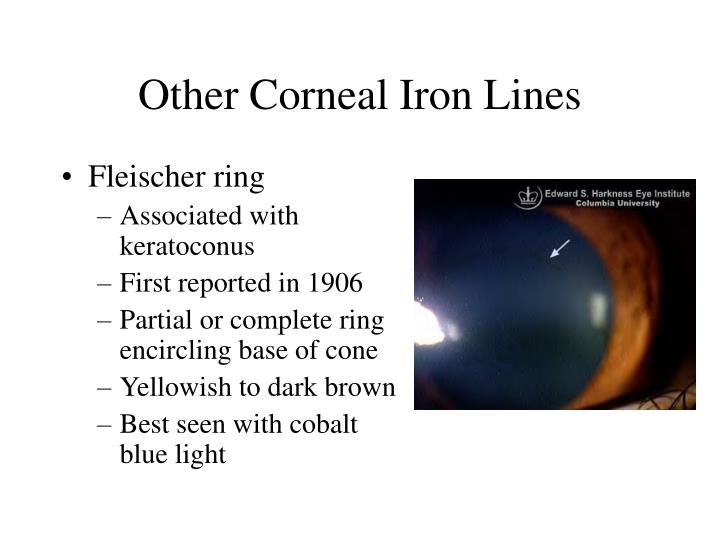 PPT - Corneal Iron Ring After Hyperopic LASIK PowerPoint Presentation ...