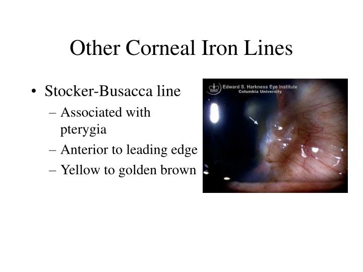 PPT - Corneal Iron Ring After Hyperopic LASIK PowerPoint Presentation ...
