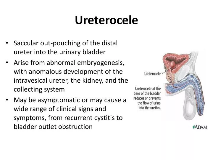 PPT - Ureterocele PowerPoint Presentation, free download - ID:1722113