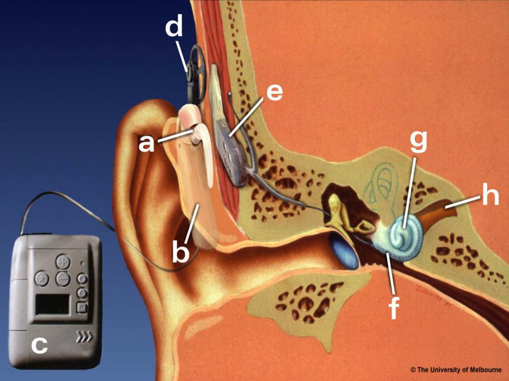 PPT - The Sound of Music, As Reported By Adult Cochlear Implant Users ...