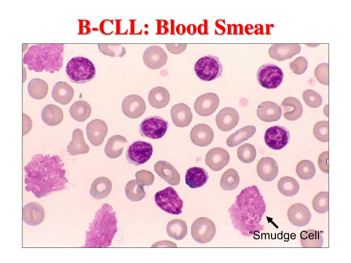 PPT - Chronic Lymphoproliferative Disorders PowerPoint Presentation ...