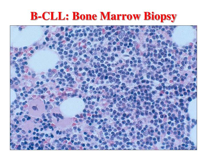 PPT - Chronic Lymphoproliferative Disorders PowerPoint Presentation ...