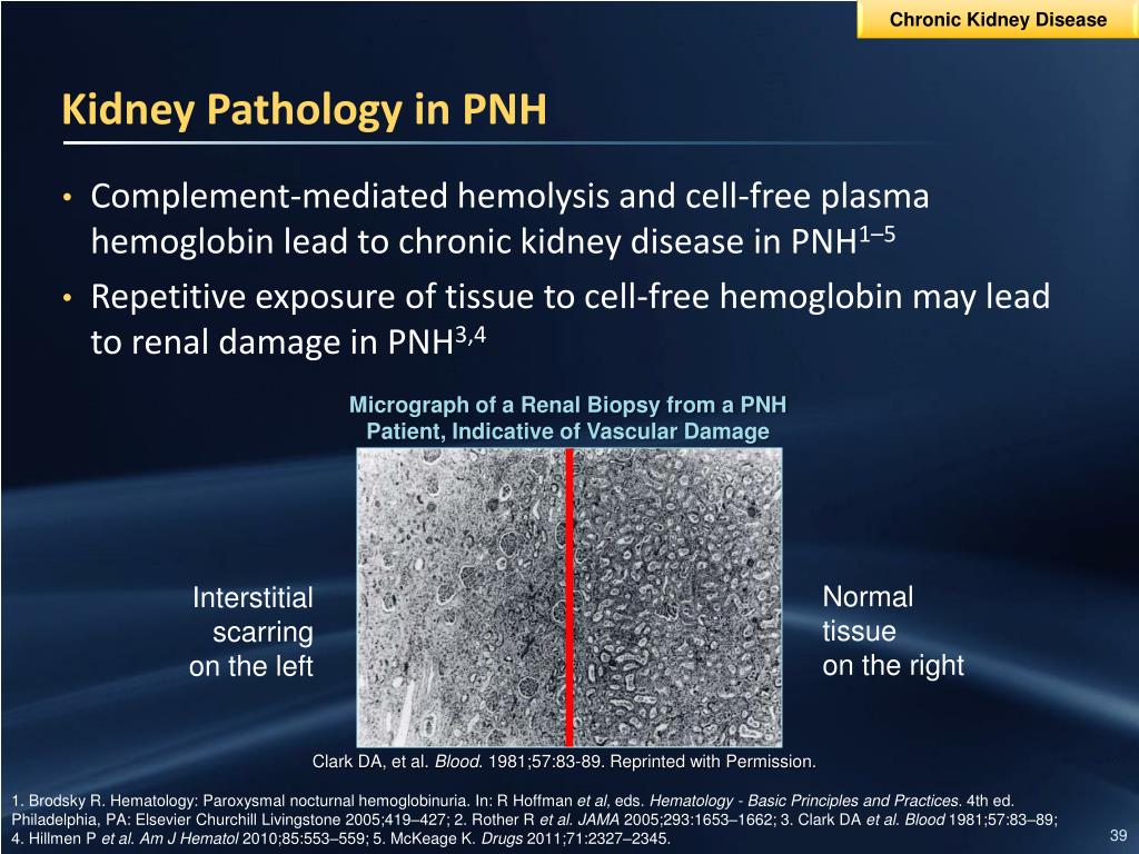 PPT - Advances in Paroxysmal Nocturnal Hemoglobinuria (PNH) PowerPoint ...