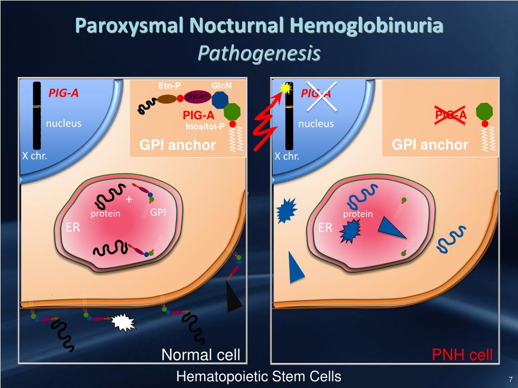 PPT - Advances in Paroxysmal Nocturnal Hemoglobinuria (PNH) PowerPoint ...