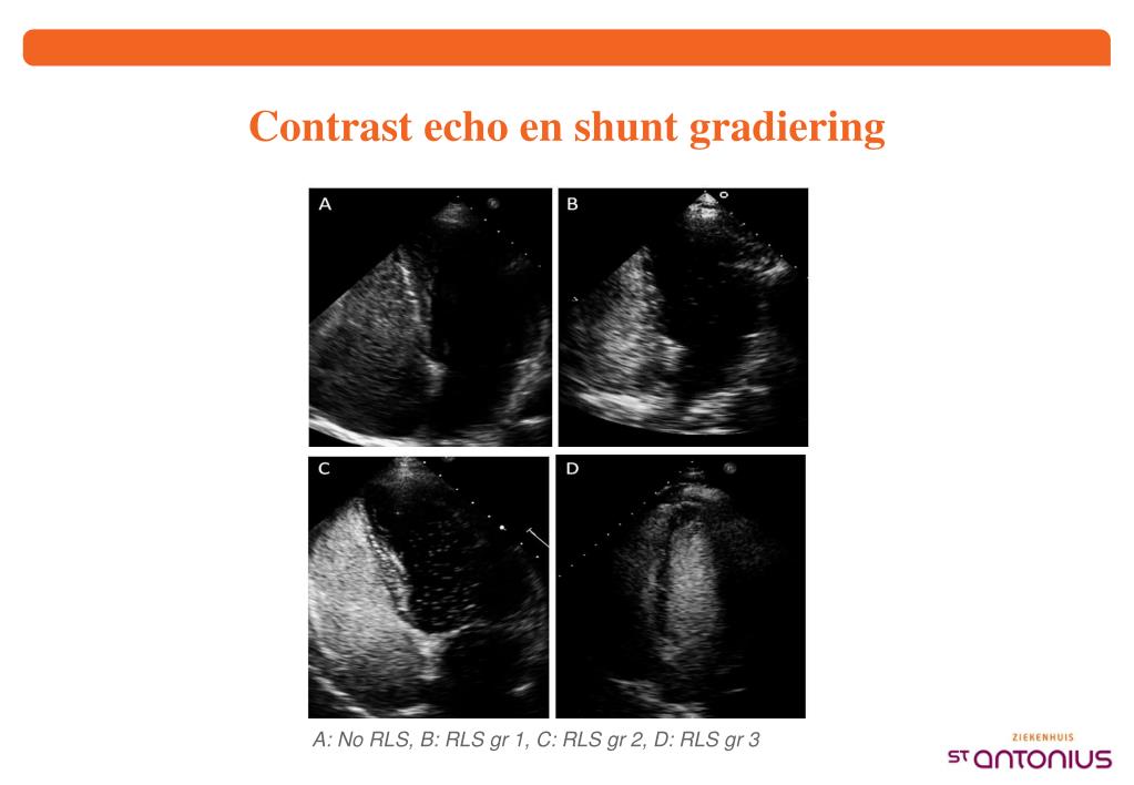 PPT - Sebastiaan Velthuis, Cardioloog in opleiding St Antonius ...