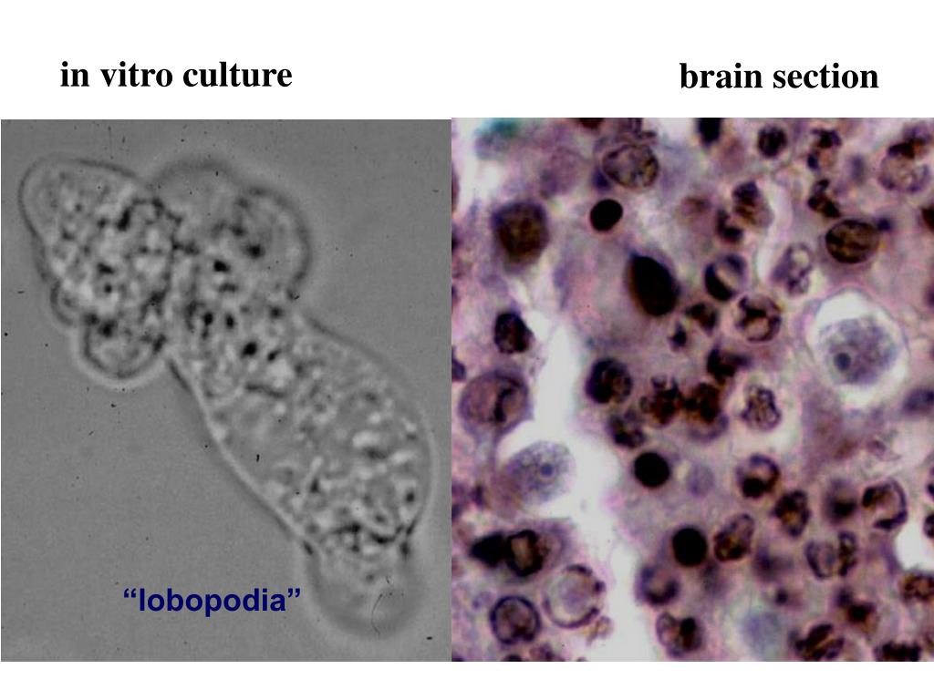 PPT - Naegleria fowleri primary amebic meningoencephalitis (PAM ...