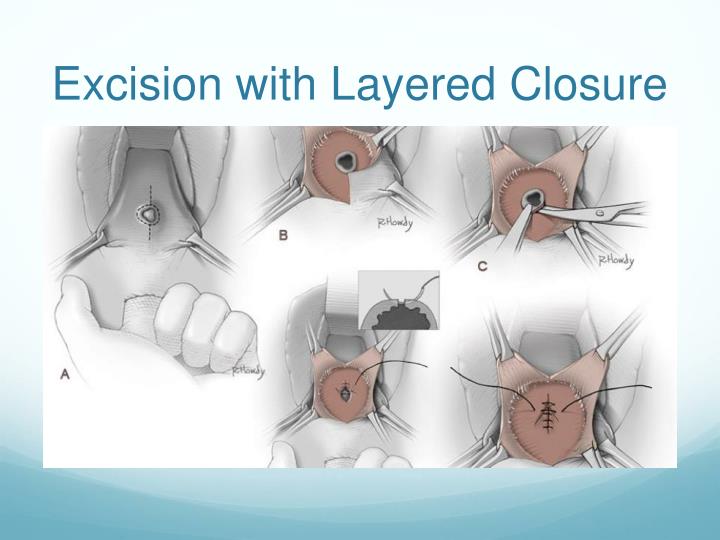 Ppt Rectovaginal Fistulas Powerpoint Presentation Id 1727204