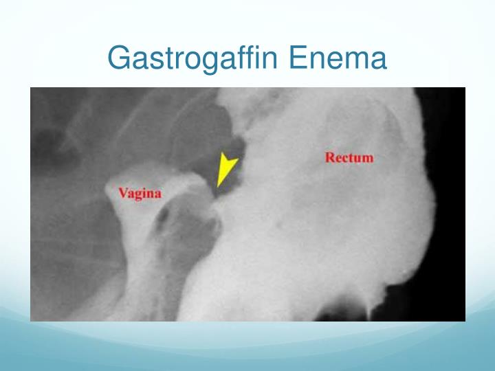 PPT - RectoVaginal Fistulas PowerPoint Presentation - ID:1727204