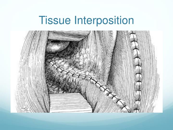 PPT - RectoVaginal Fistulas PowerPoint Presentation - ID:1727204
