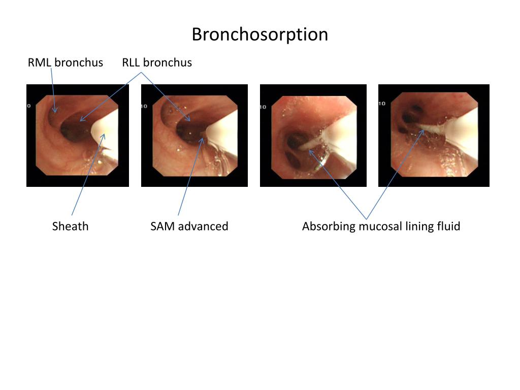 PPT - Rhinovirus Induces Th2 cytokines and chemokines in the Airways in ...