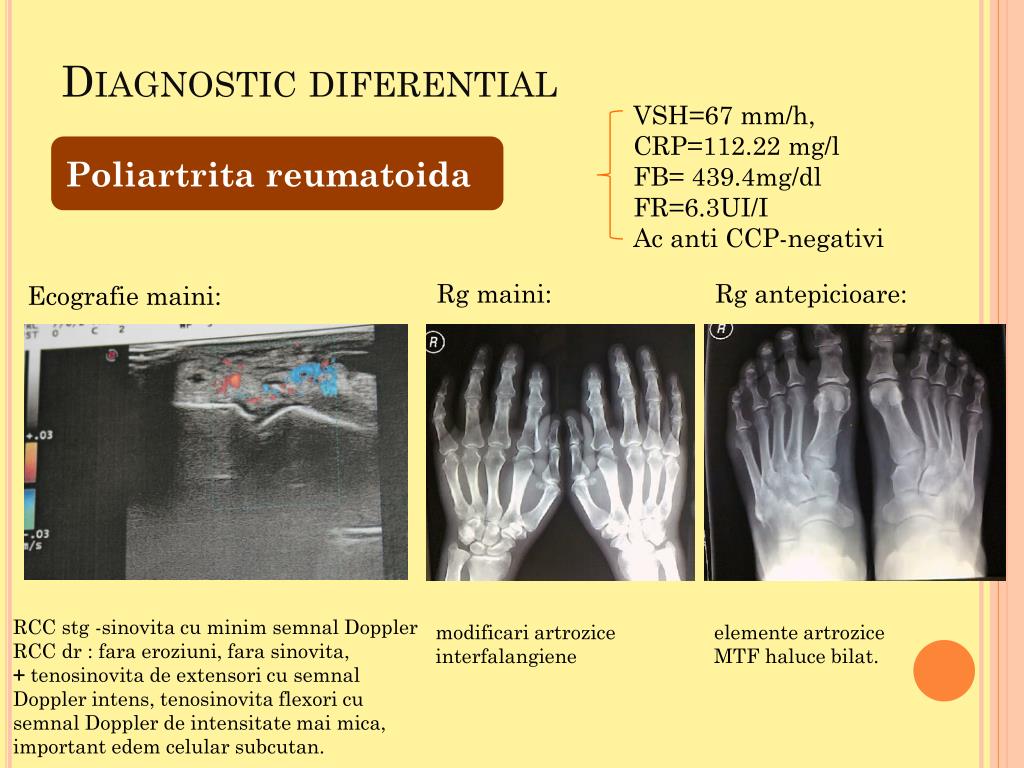 PPT - Palarie-ntr-un picior, ghici ciuperca ce-i ? PowerPoint ...