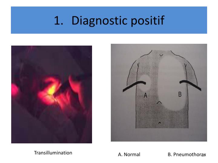 PPT - PNEUMOTHORAX du NN PowerPoint Presentation - ID:1733123