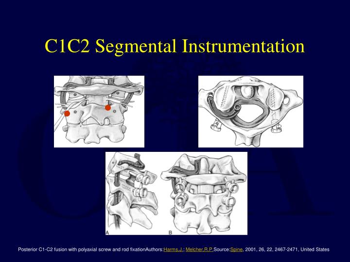 PPT - Upper Cervical Spine Fractures PowerPoint Presentation - ID:1733260