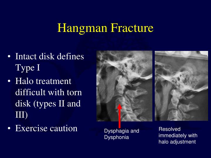 PPT - Upper Cervical Spine Fractures PowerPoint Presentation - ID:1733260
