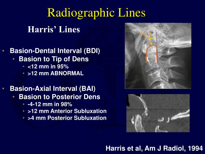 PPT - Upper Cervical Spine Fractures PowerPoint Presentation - ID:1733260