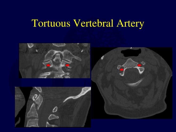 PPT - Upper Cervical Spine Fractures PowerPoint Presentation - ID:1733260