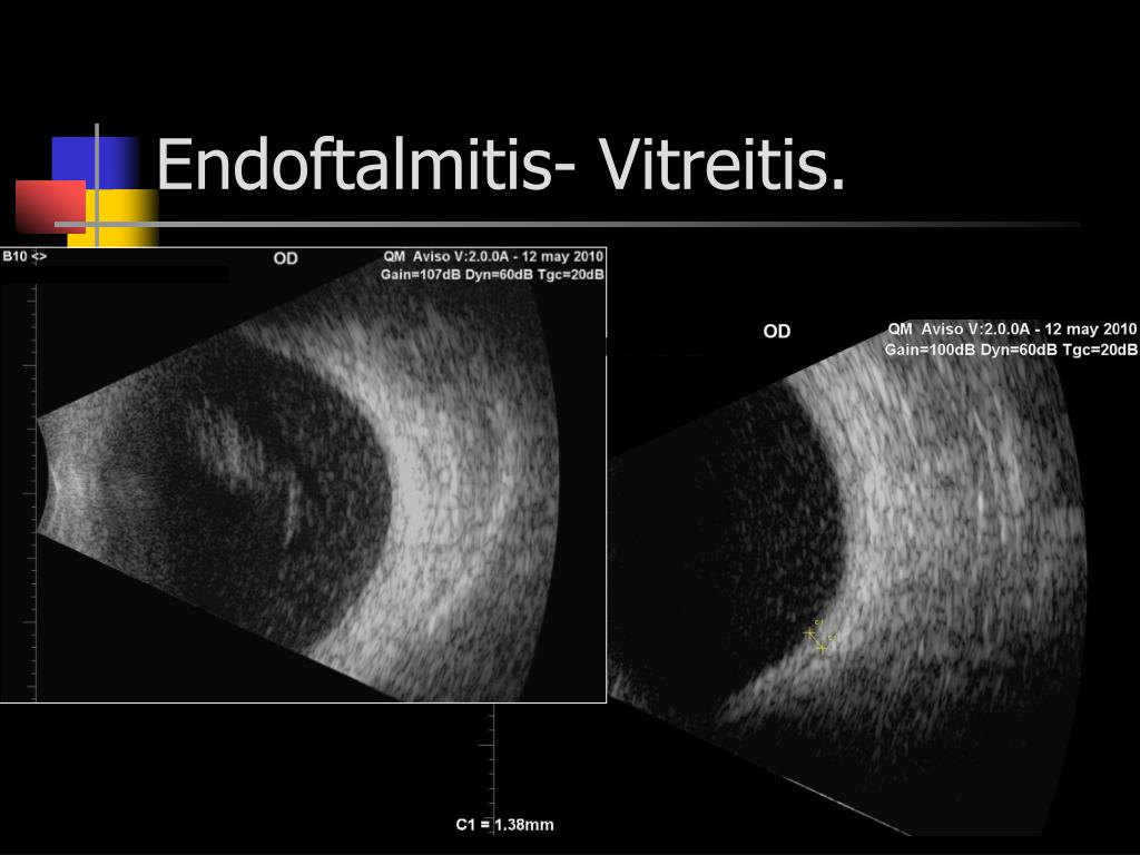 PPT - Ultrasonidos en Trauma Ocular OSCAR ORTIZ SEPULVEDA. PowerPoint ...