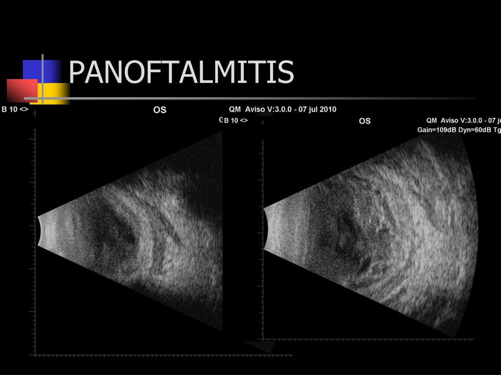 PPT - Ultrasonidos en Trauma Ocular OSCAR ORTIZ SEPULVEDA. PowerPoint ...