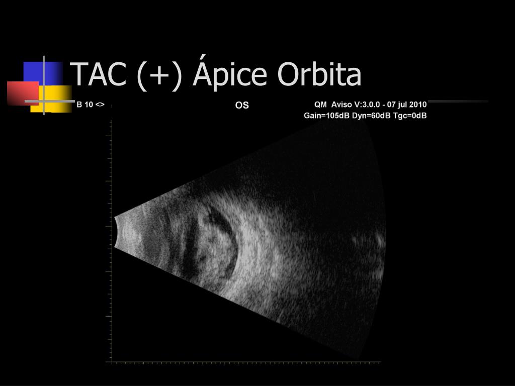 PPT - Ultrasonidos en Trauma Ocular OSCAR ORTIZ SEPULVEDA. PowerPoint ...