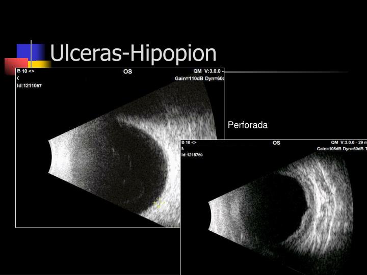 PPT - Ultrasonidos en Trauma Ocular OSCAR ORTIZ SEPULVEDA. PowerPoint ...