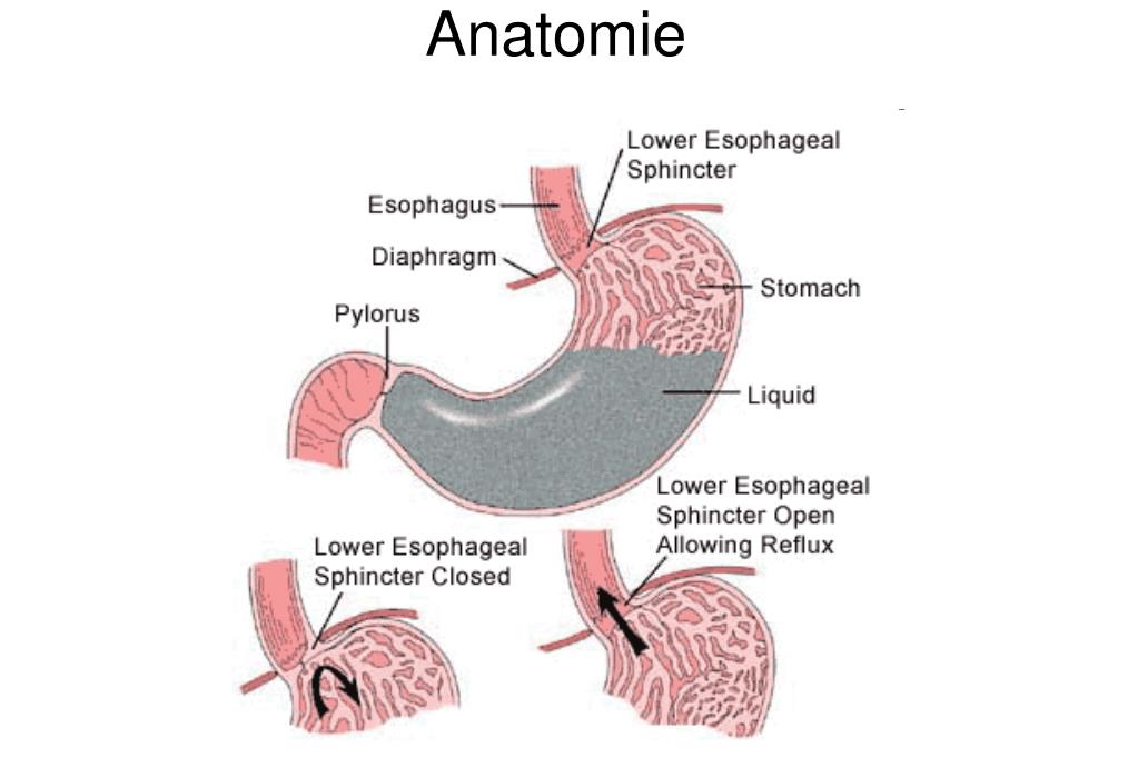 PPT - Reflux gastro-oesophagien Hernie hiatale PowerPoint Presentation ...
