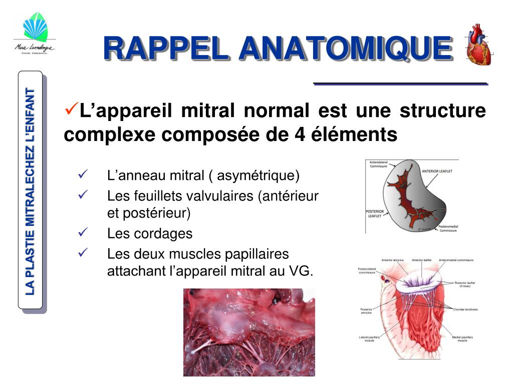 PPT - LA PLASTIE MITRALE CHEZ L’ENFANT PowerPoint Presentation, free ...