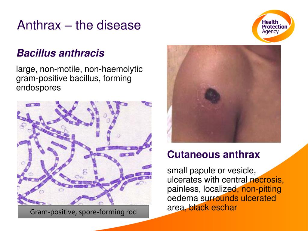 PPT - Inhalation anthrax: a single case in North London Dr Sudy Anaraki ...