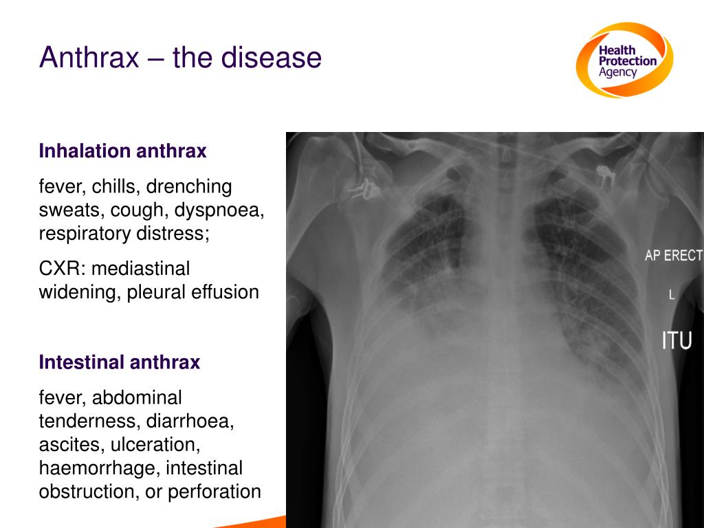 PPT - Inhalation anthrax: a single case in North London Dr Sudy Anaraki ...
