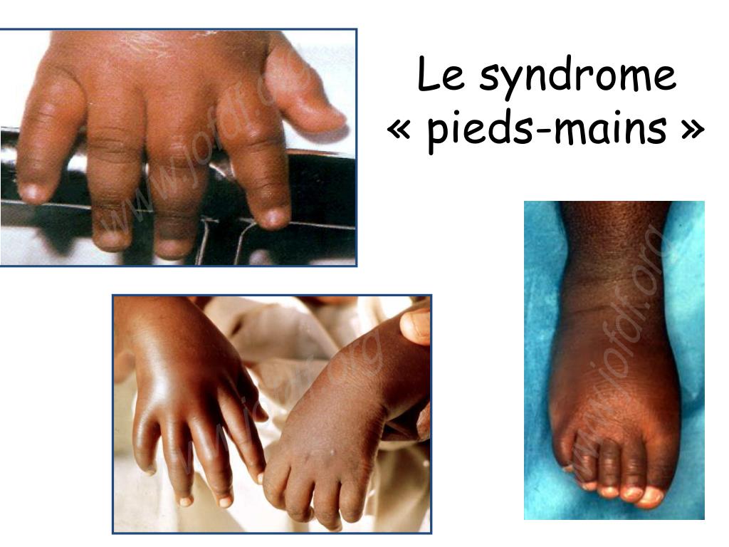PPT - Les complications ostéo-articulaires chez l’enfant drépanocytaire ...