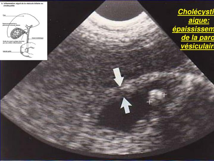 PPT - CHOLECYSTITE AIGUE PowerPoint Presentation - ID:1735003