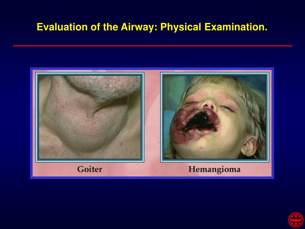 PPT - The Difficult Airway Rafael Ortega, M.D. Associate Professor of ...