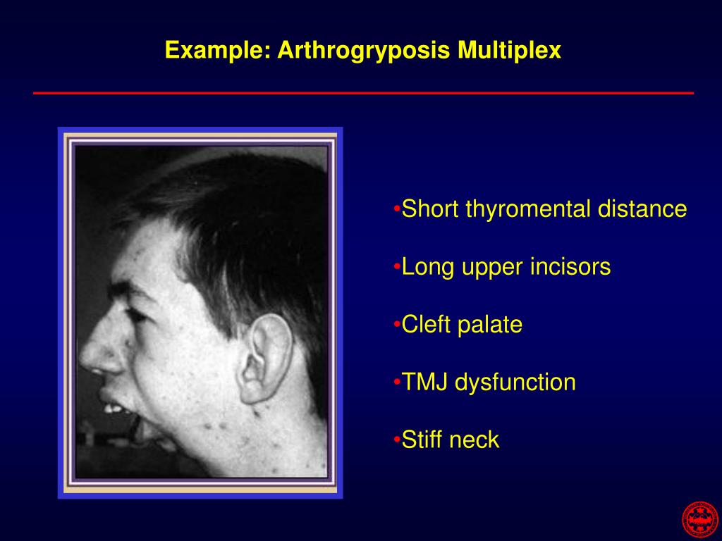 PPT - The Difficult Airway Rafael Ortega, M.D. Associate Professor of ...