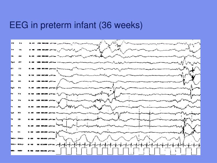 PPT - Cerebral Function Monitoring Amplitude-Integrated EEG – aEEG ...