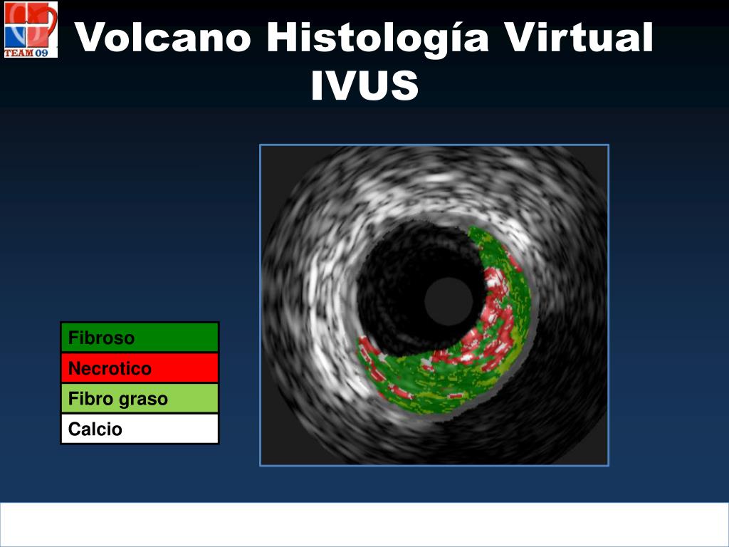 PPT - ANGIOGRAFIA vs IVUS PowerPoint Presentation, free download - ID ...